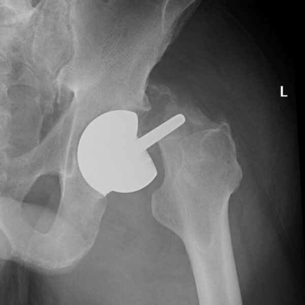 Why Hip Resurfacing Is a Bad Choice—and Why Some Surgeons Still Push It ...