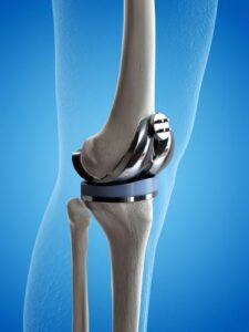 Understanding Your Knee Replacement Options: Why Cemented Implants ...